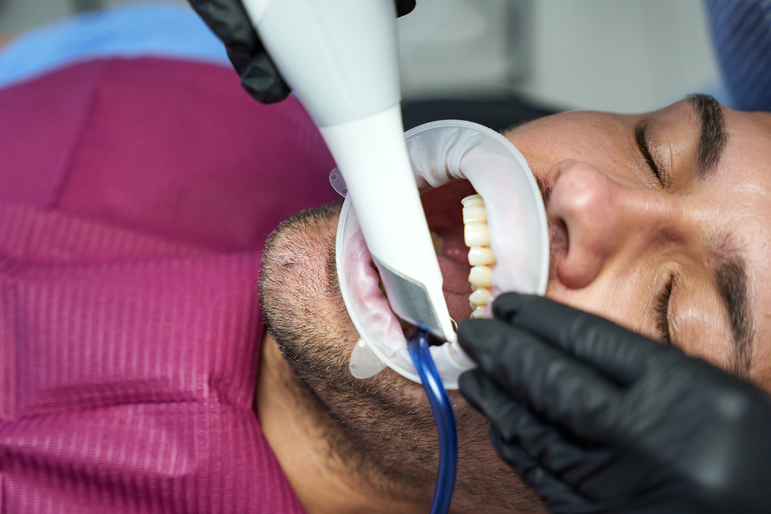 Biomimetic Restorations – Method Aesthetics